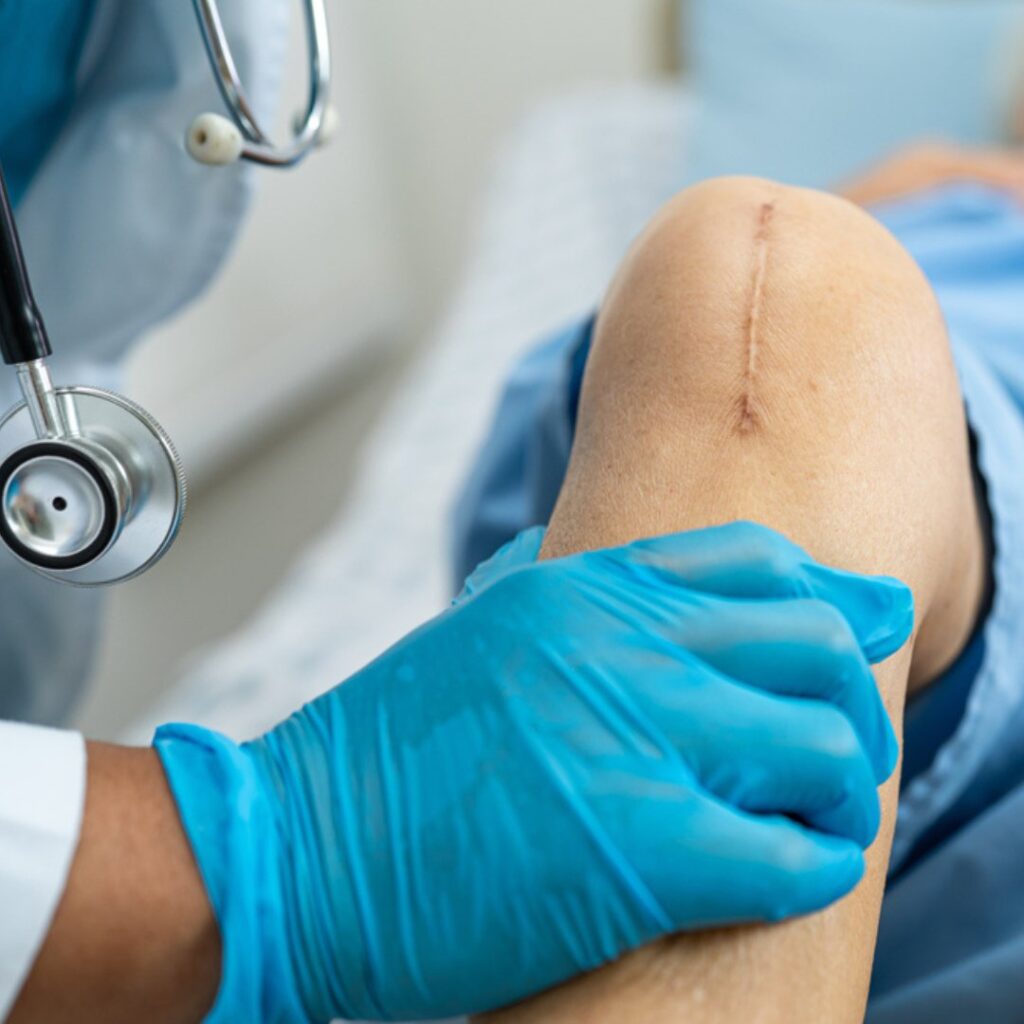 Manipulation Under Anesthesia After TKR Surgery